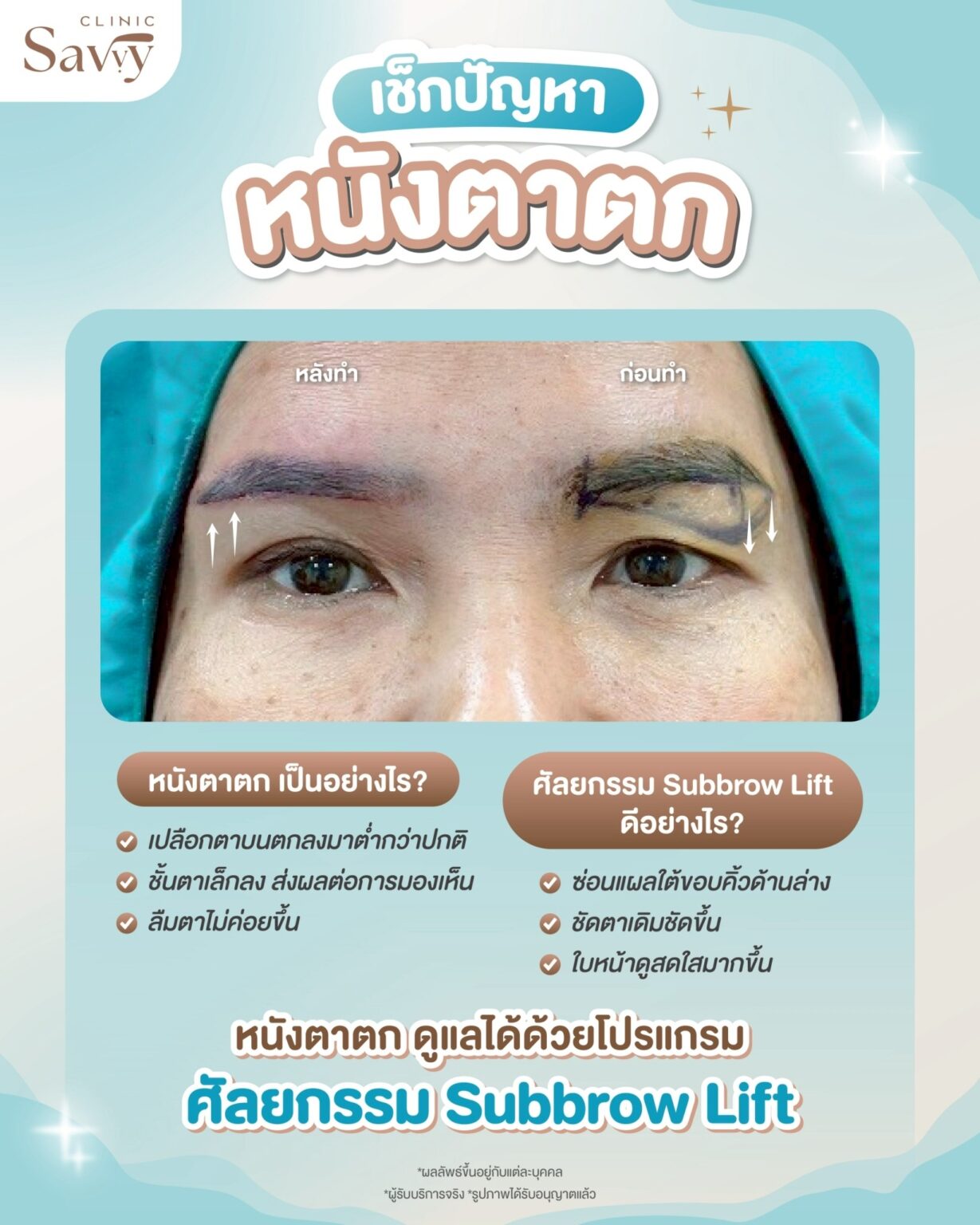 เช็กปัญหา หนังตาตก - แซฟวี่ คลินิกความงามและศัลยกรรม อ่อนนุช ลาดกระบัง
